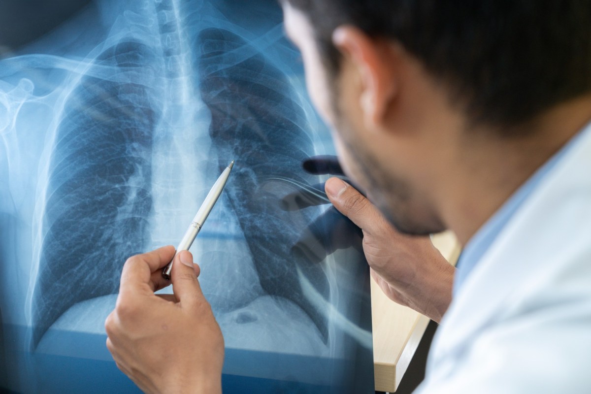 A New Lung Cancer Treatment Dramatically Slowed Its Growth - InsideHook